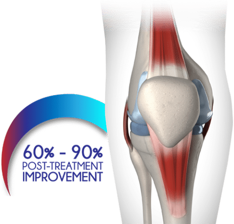 Tendonitis - Knee Pain Doctors in New Jersey