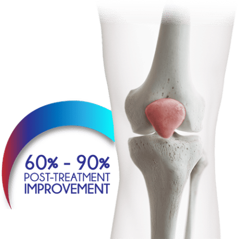 Patellofemoral Syndrome - Knee Pain Doctors in New Jersey